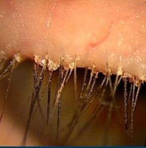 Discover Demodex | Look at the Lids