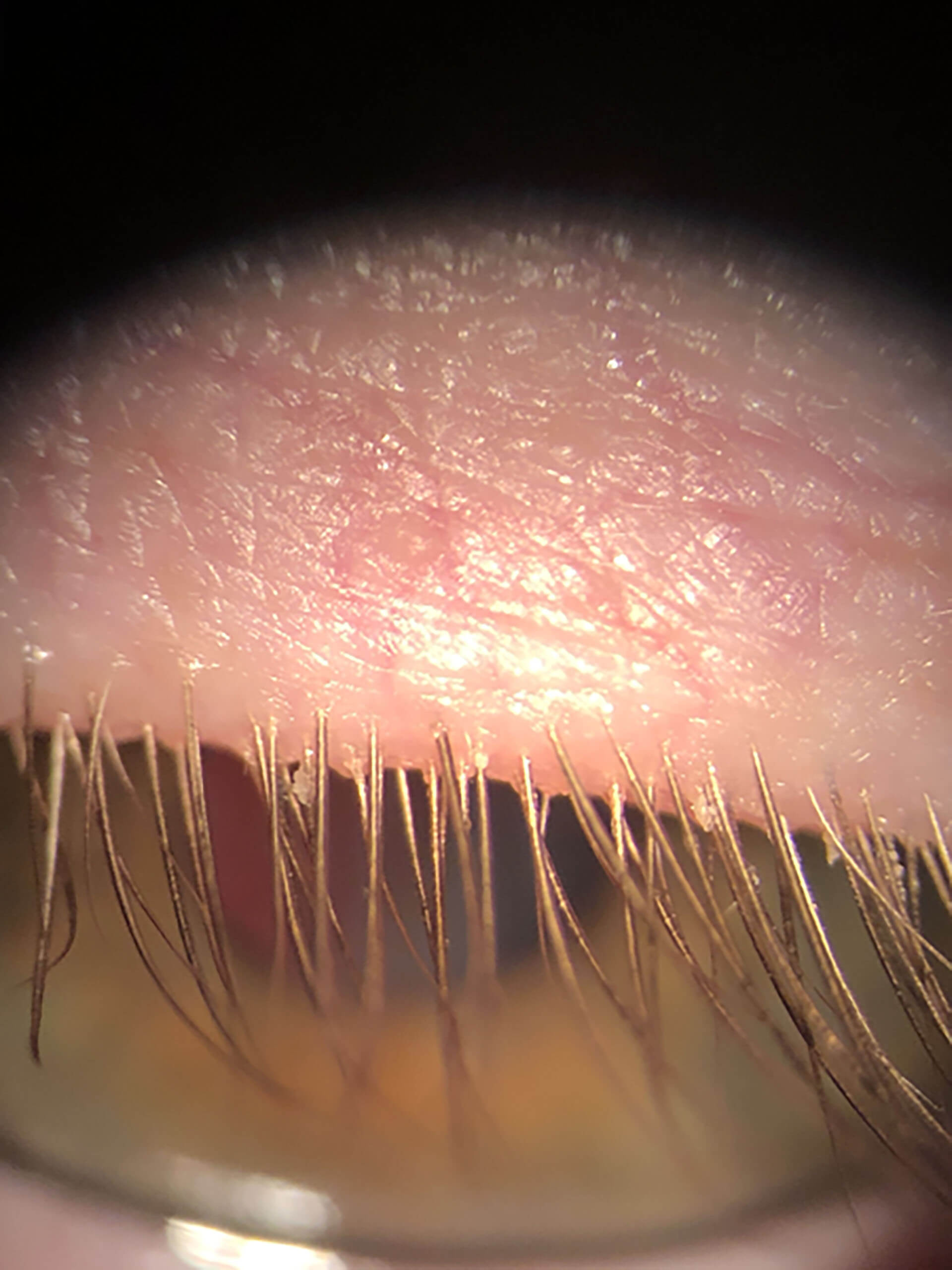 Look at the Lids for Collarette Detection | Look at the Lids