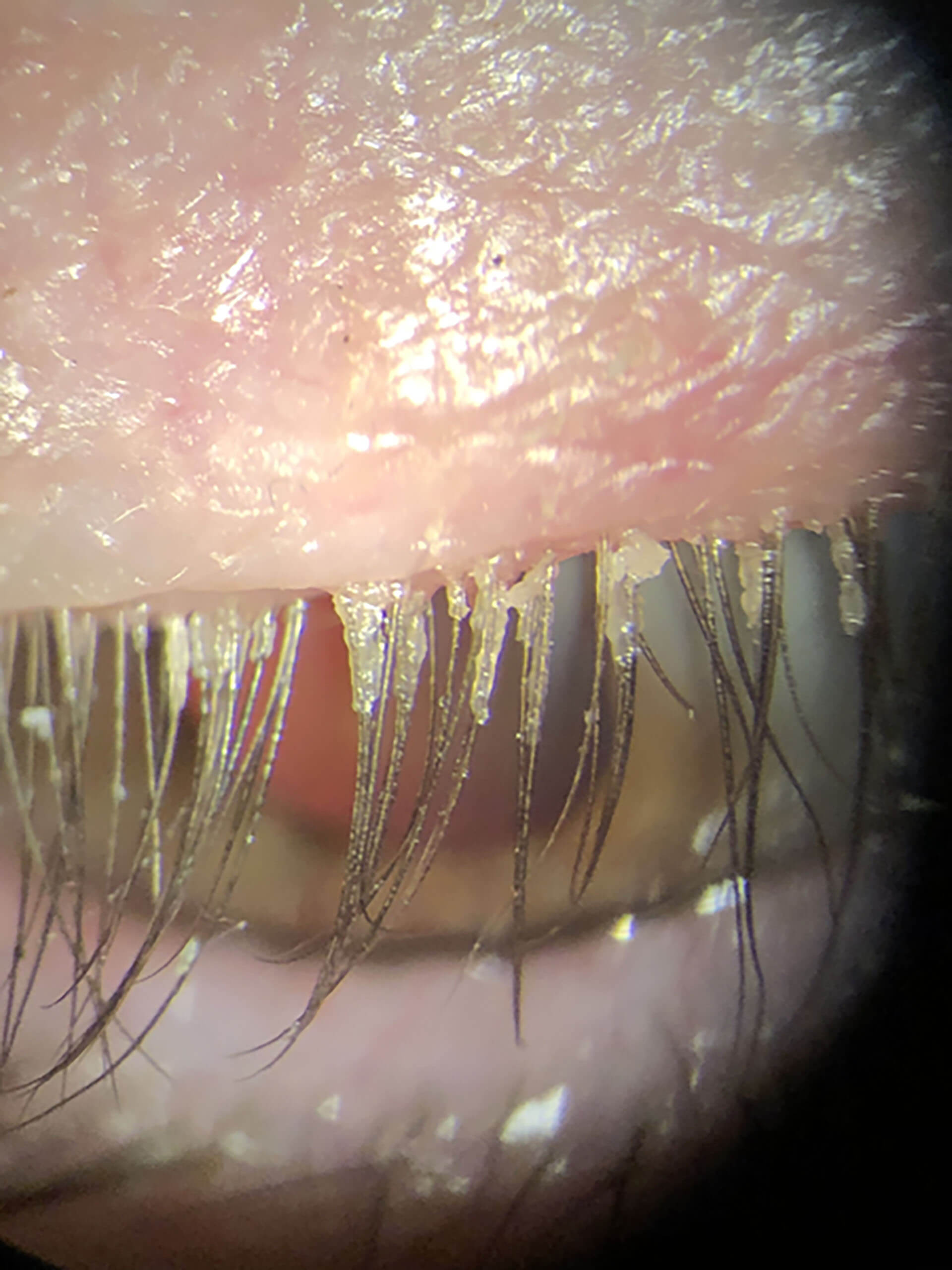 Look at the Lids for Collarette Detection | Look at the Lids