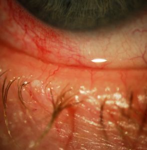 Discover Demodex | Look at the Lids