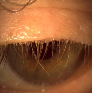 Look at the Lids for Collarette Detection | Look at the Lids
