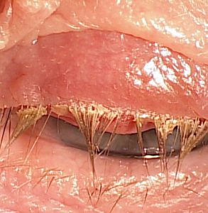 Discover Demodex | Look at the Lids