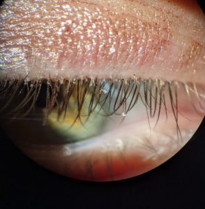 Discover Demodex | Look at the Lids